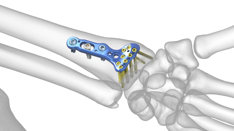 Hand Wrist orif | Orthosoma